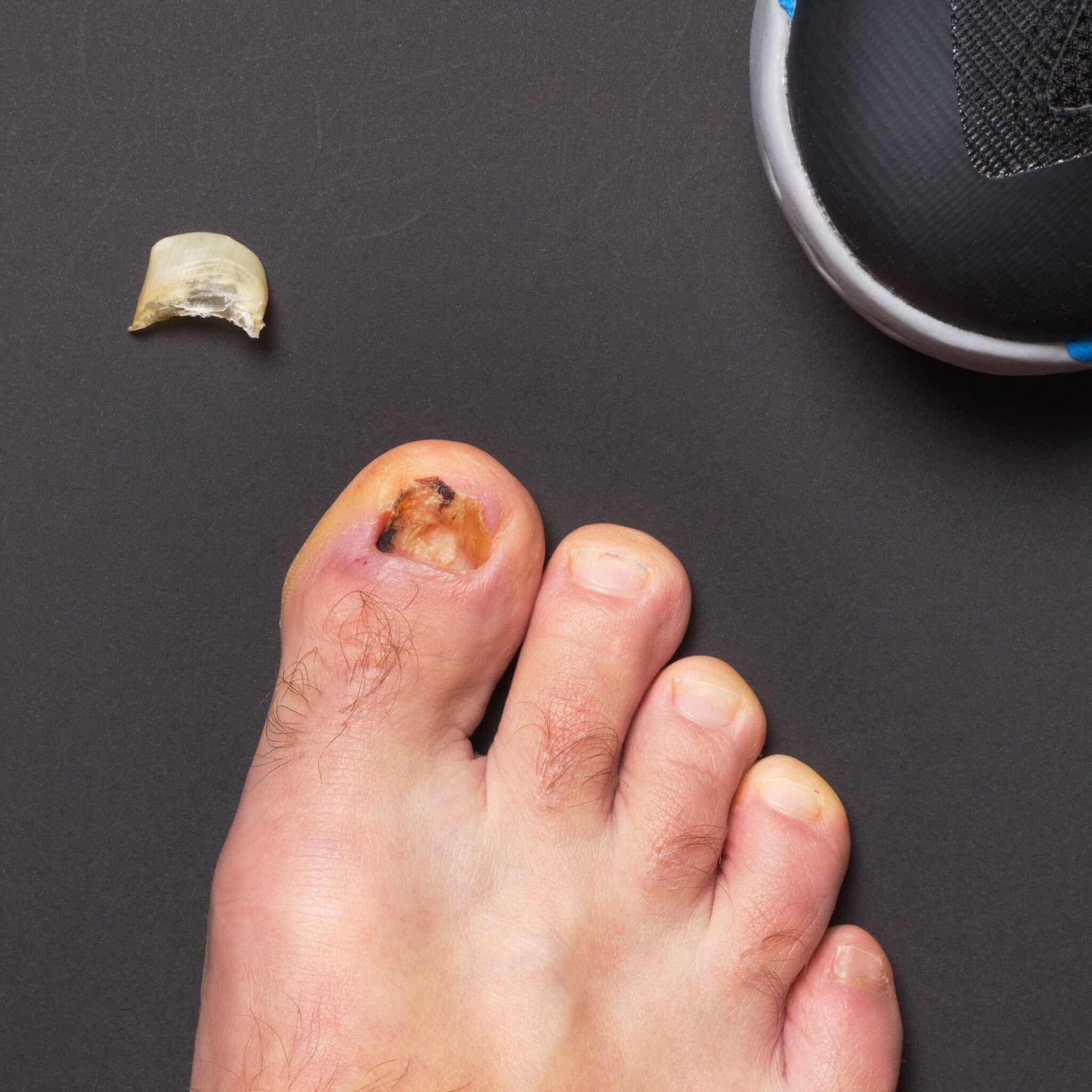 เล็บเท้าจม เนื้อบริเวณขอบเล็บส่วนปลายหนาตัวขึ้น เล็บไม่สามารถงอกพ้นปลายนิ้ว